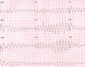 L'arrêt cardiaque et sa réanimation pour les soignants